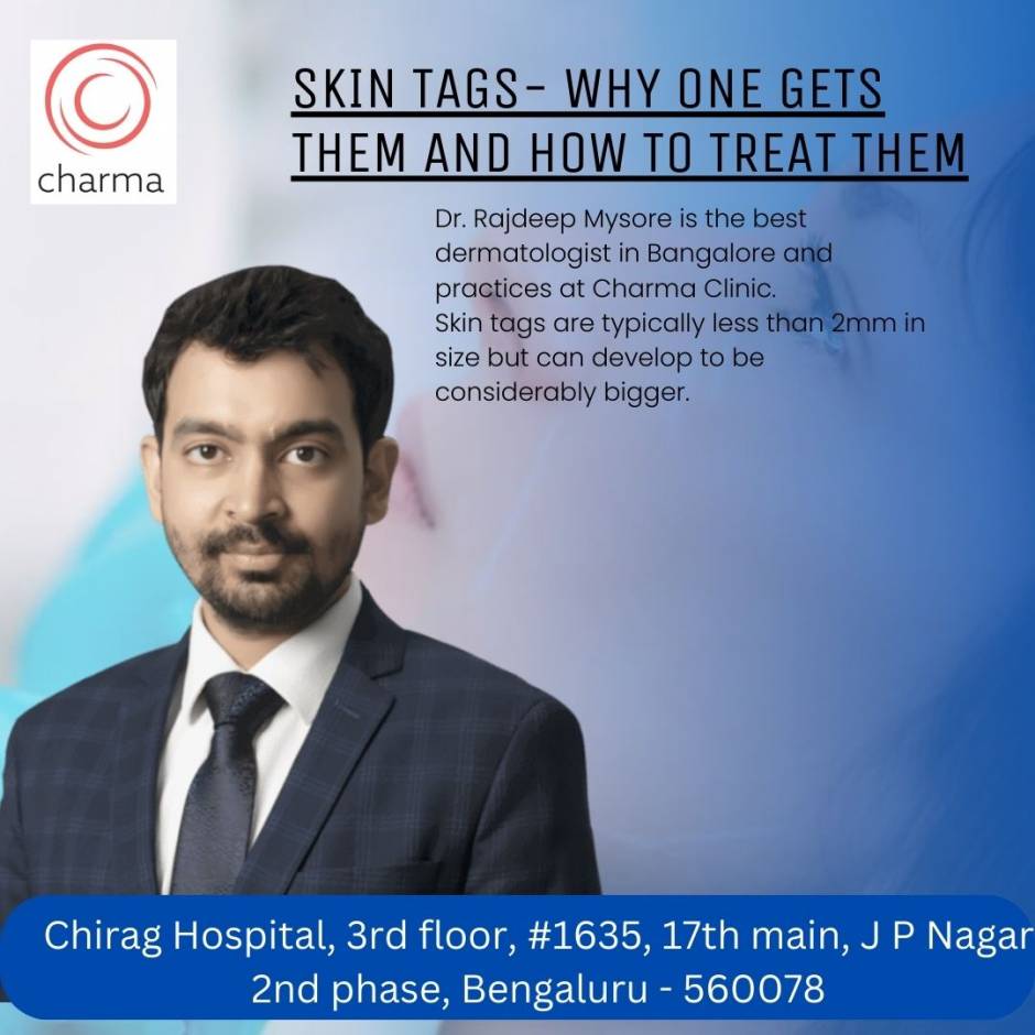 Skin Tags - Why One Gets Them And How To Treat Them