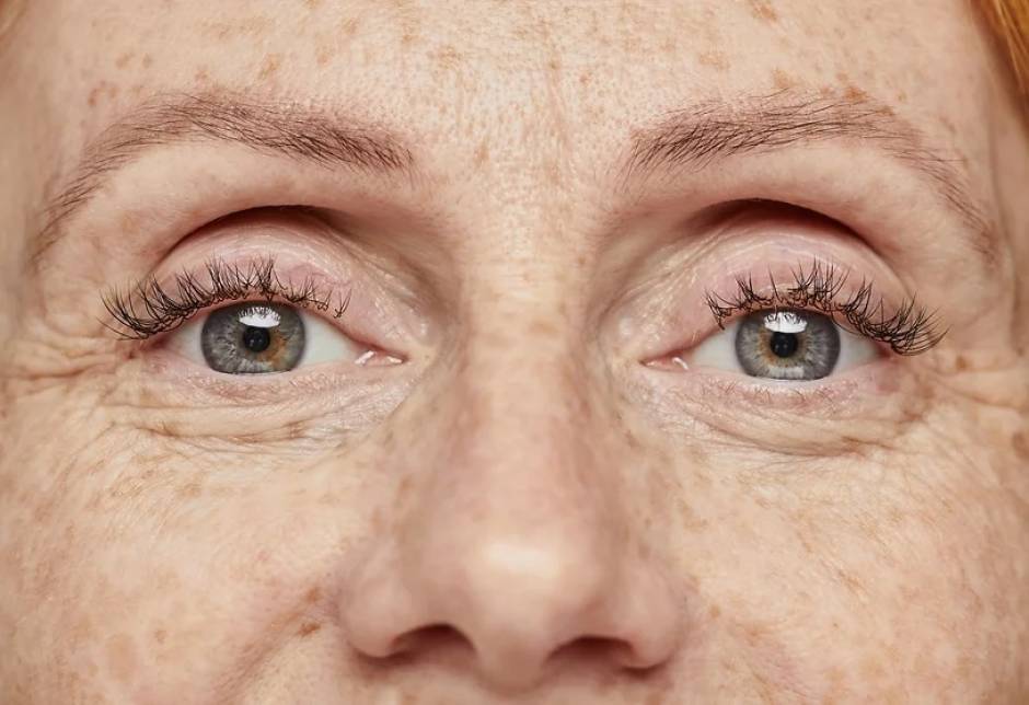 Hypertensive Retinopathy Symptoms Causes And Treatment