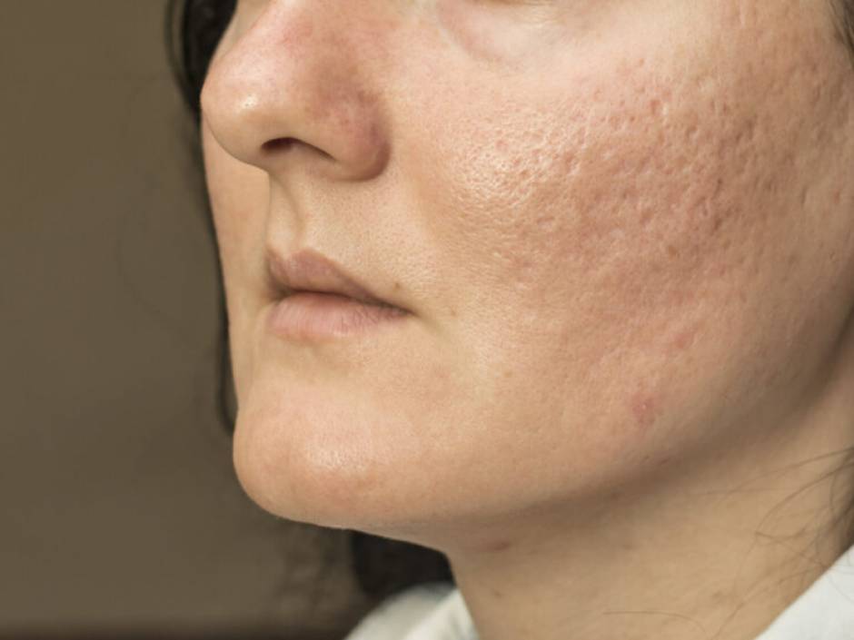 Breaking Chains Of Cystic Acne Treatment: A Guide to Effec